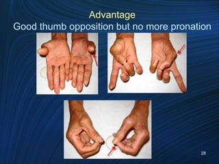 Burkhalter's Procedure | PDF