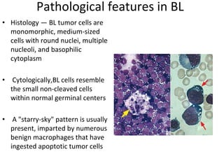 Burkitt lymphoma.ppt