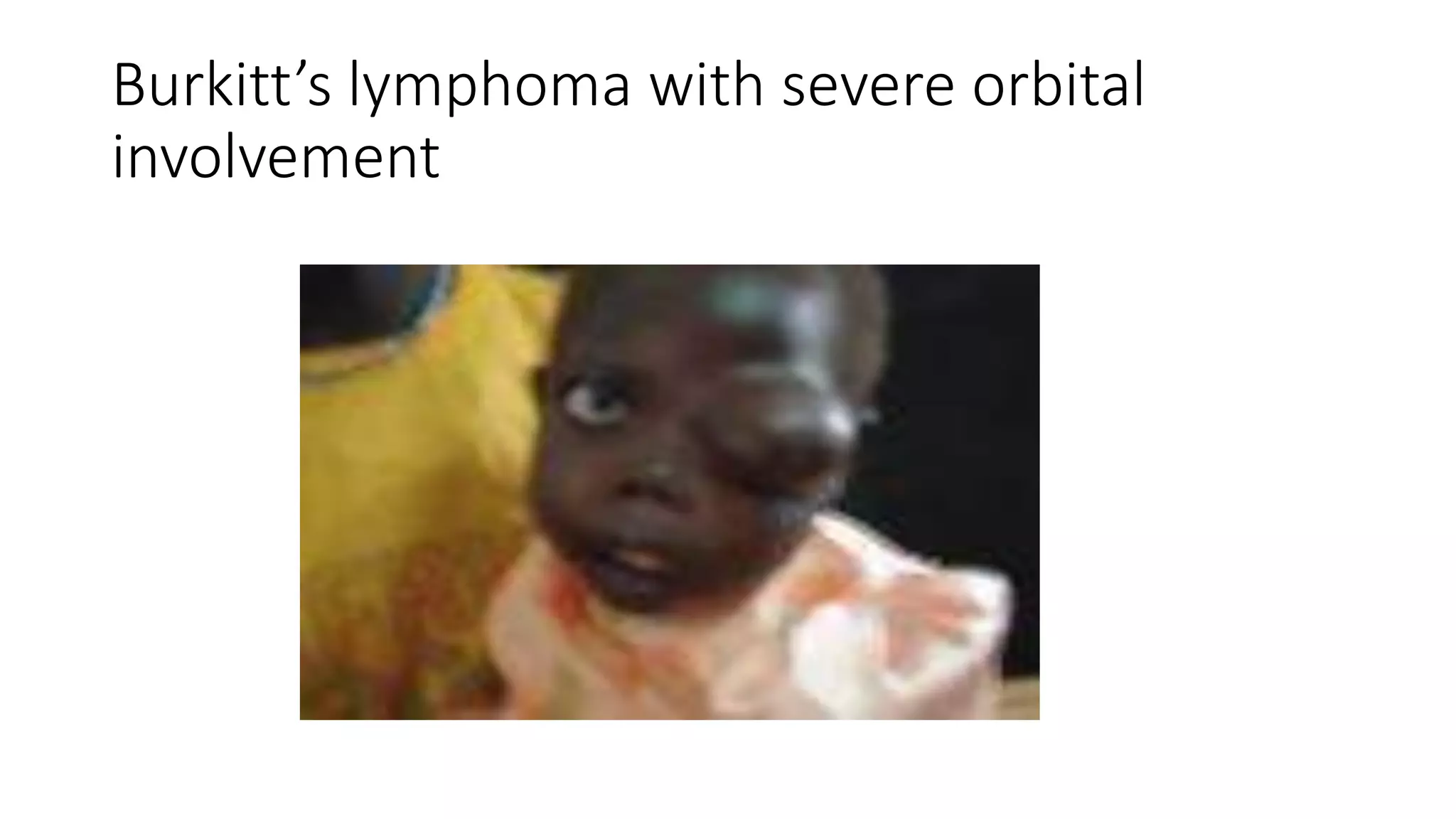Burkitt lymphoma.pptx