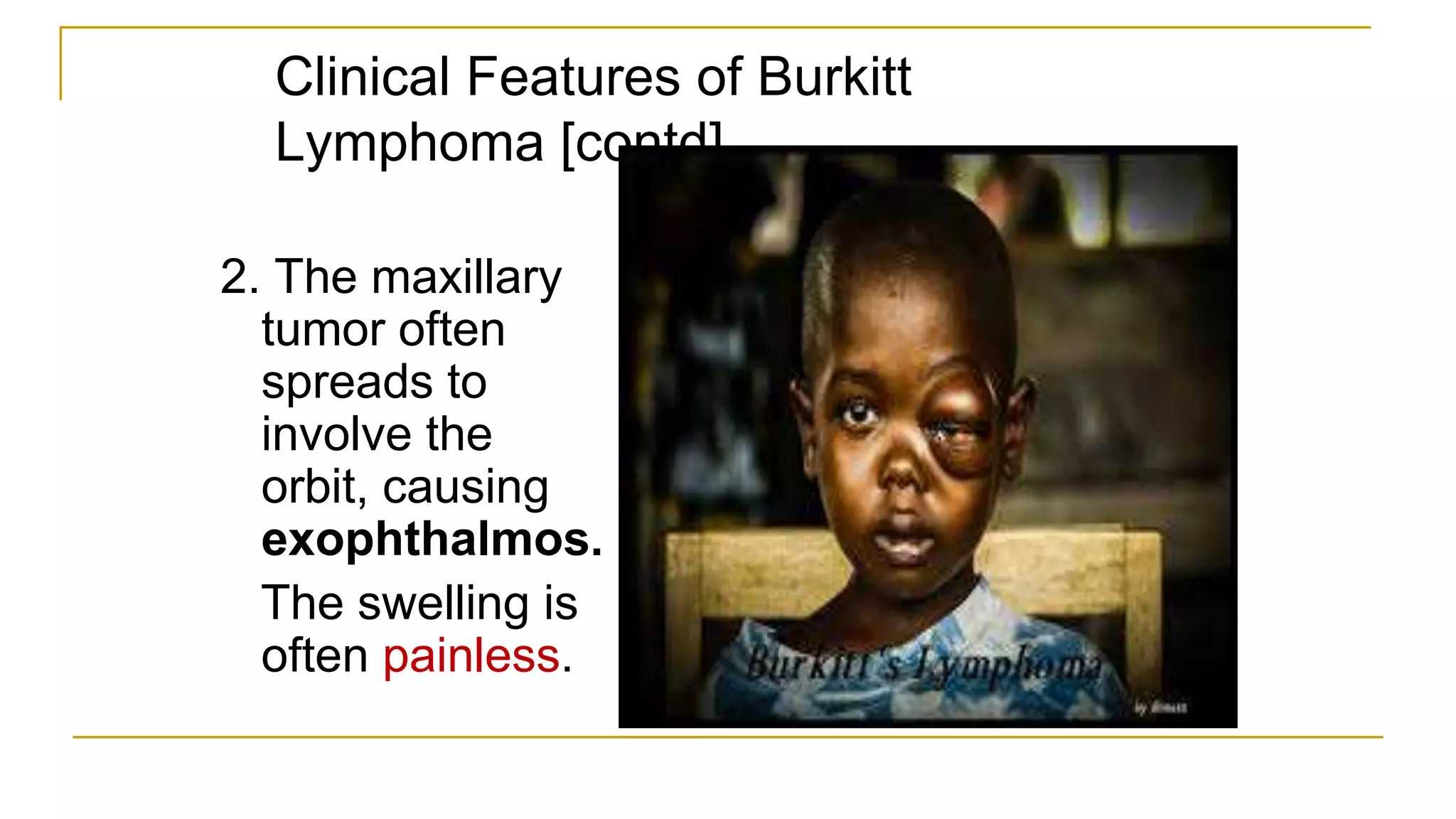 Burkitt Lymphoma GROUP A BATCH 2 PRESENTATION (1).pptx
