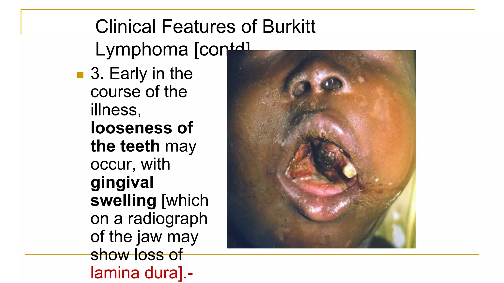 Burkitt Lymphoma GROUP A BATCH 2 PRESENTATION (1).pptx