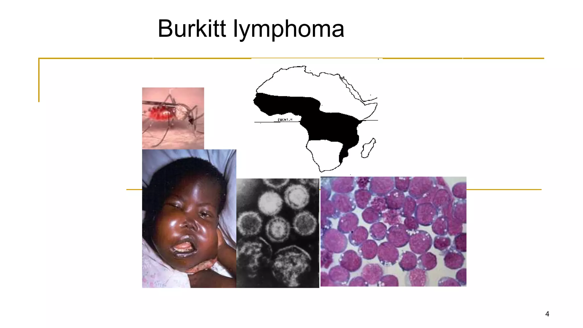 Burkitt Lymphoma GROUP A BATCH 2 PRESENTATION (1).pptx
