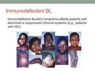 Burkitts lymphoma and abdominal masses | PPT