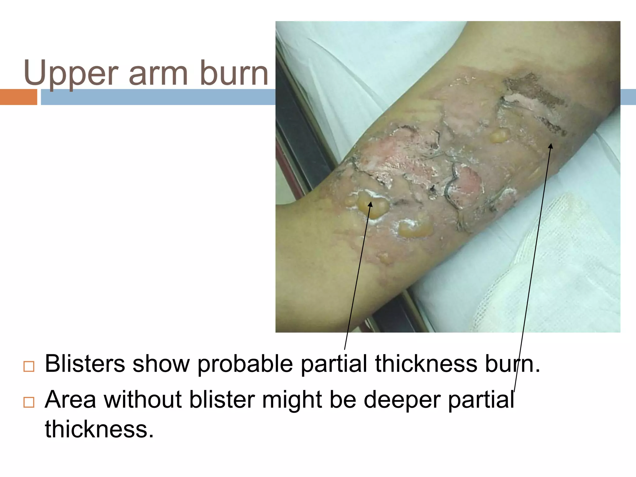 Burn | PPTX