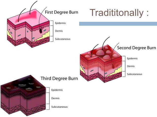 Burn | PPTX | First Aid | Injuries
