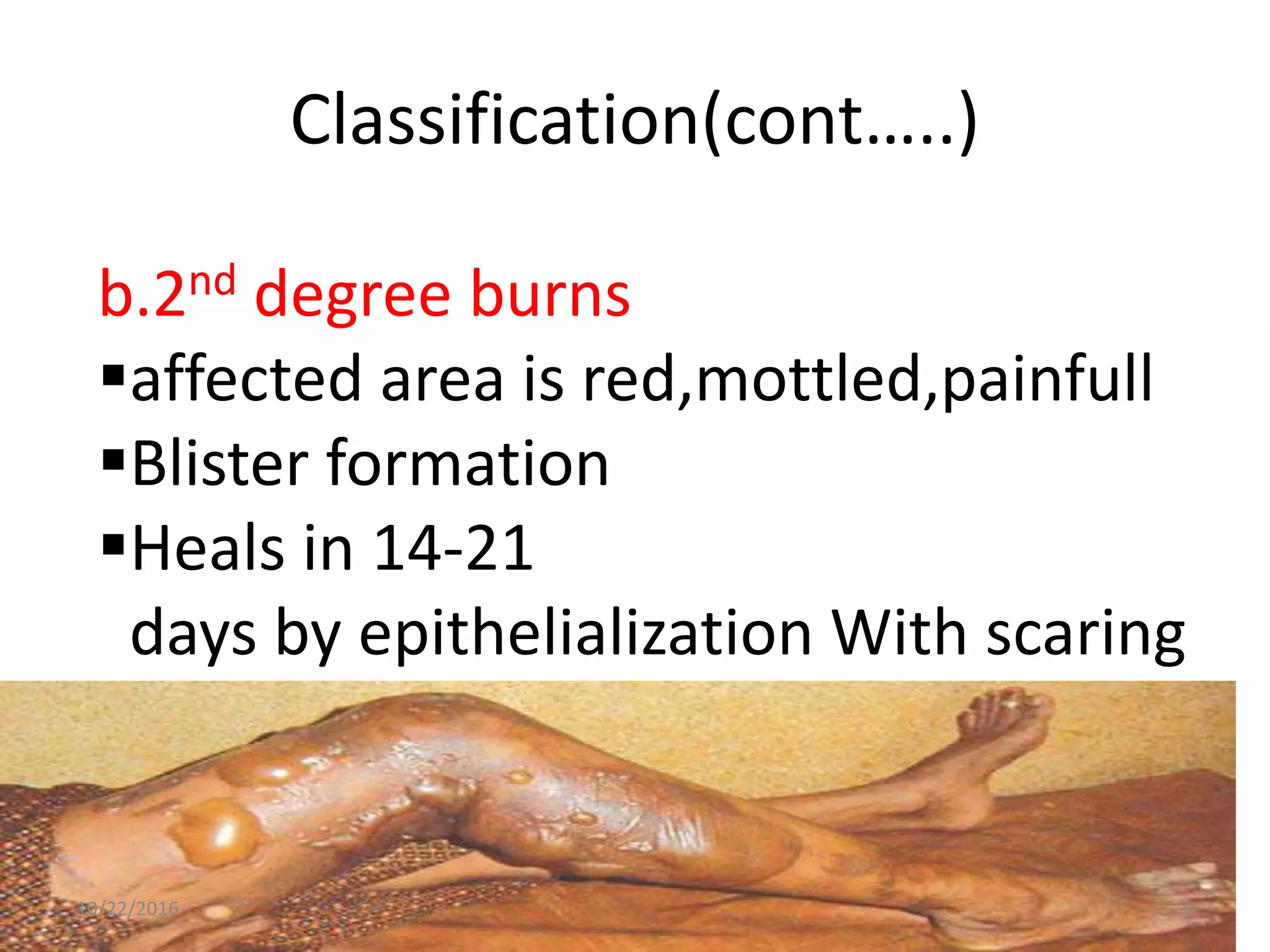 Burn classification and management | PPTX