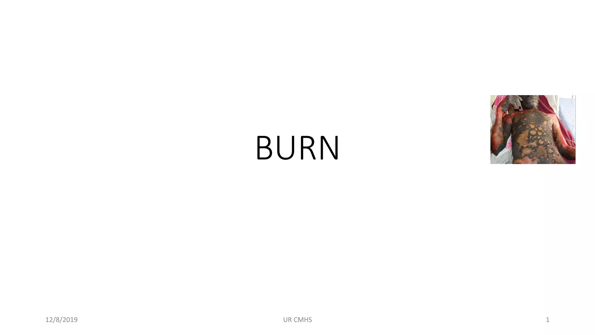 Burn | PPT
