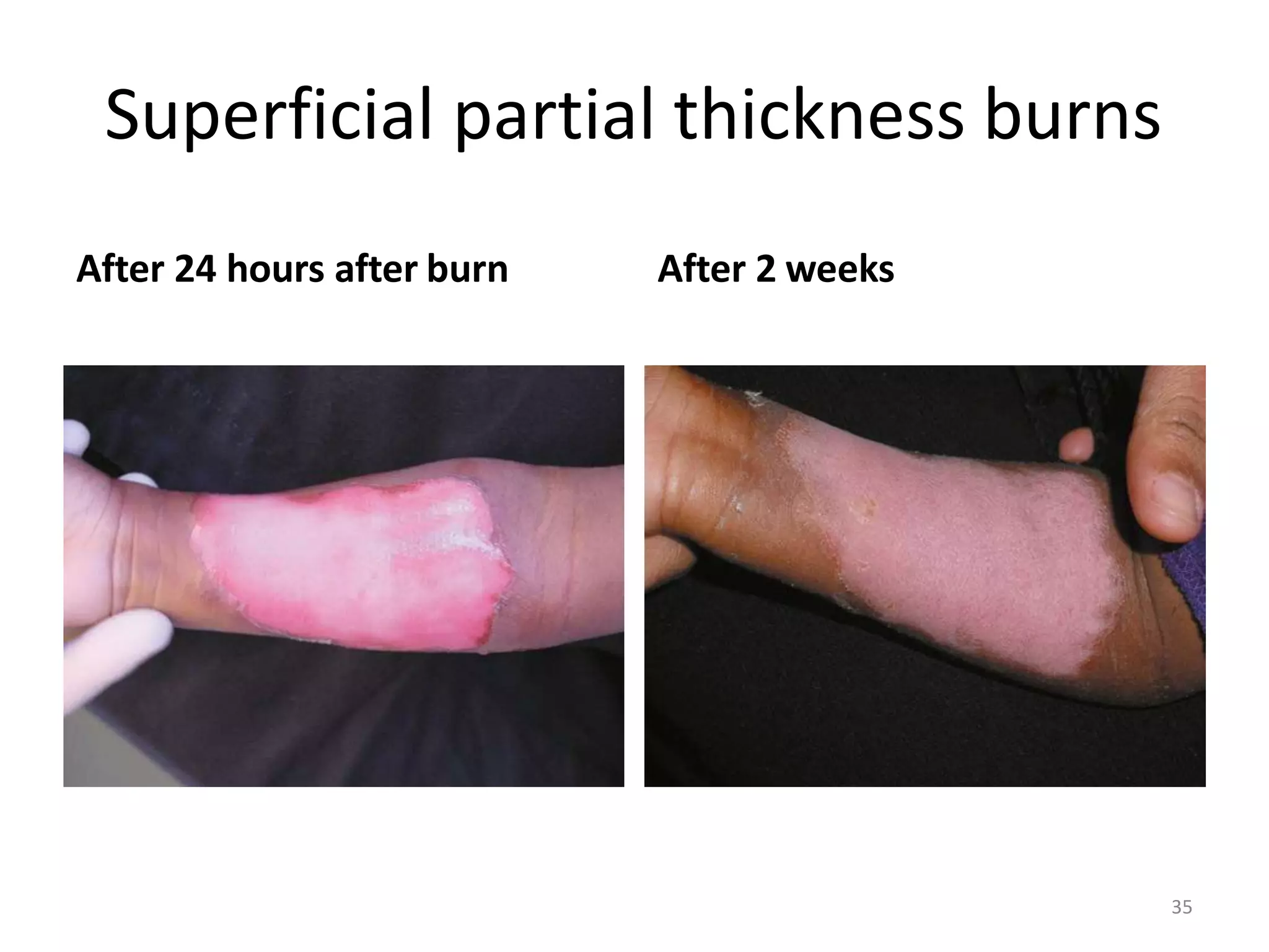 Burn | PPTX