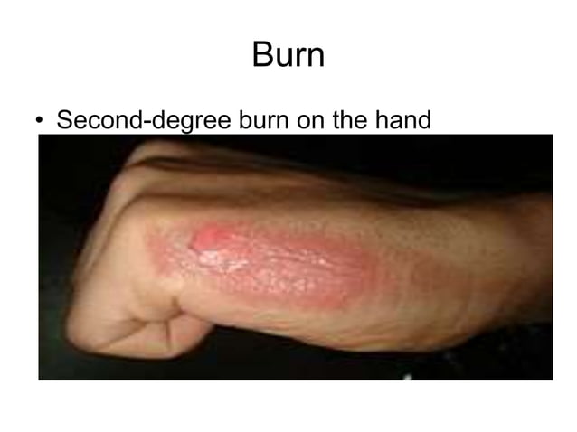 Burn.ppt