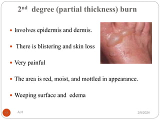 Burn.pptx for first aid student of nursing | PPTX