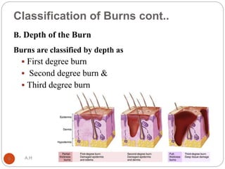 Burn.pptx for first aid student of nursing | PPTX
