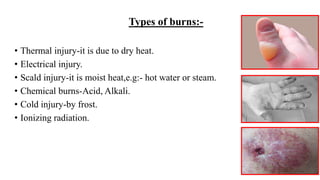 Understanding Burns: A Comprehensive Overview" | PPTX