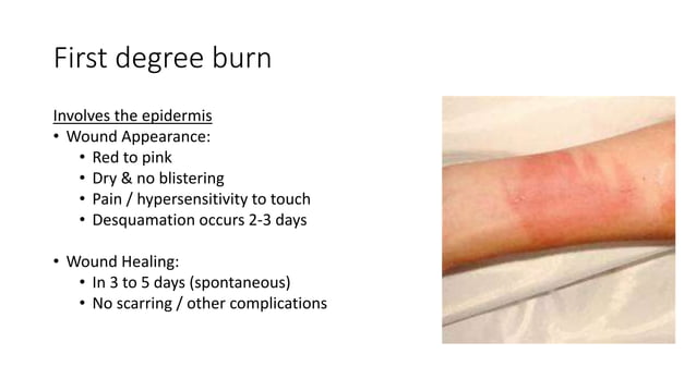 BURN. A brief note on burn and its management | PPT