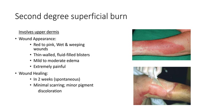 BURN. A brief note on burn and its management | PPT