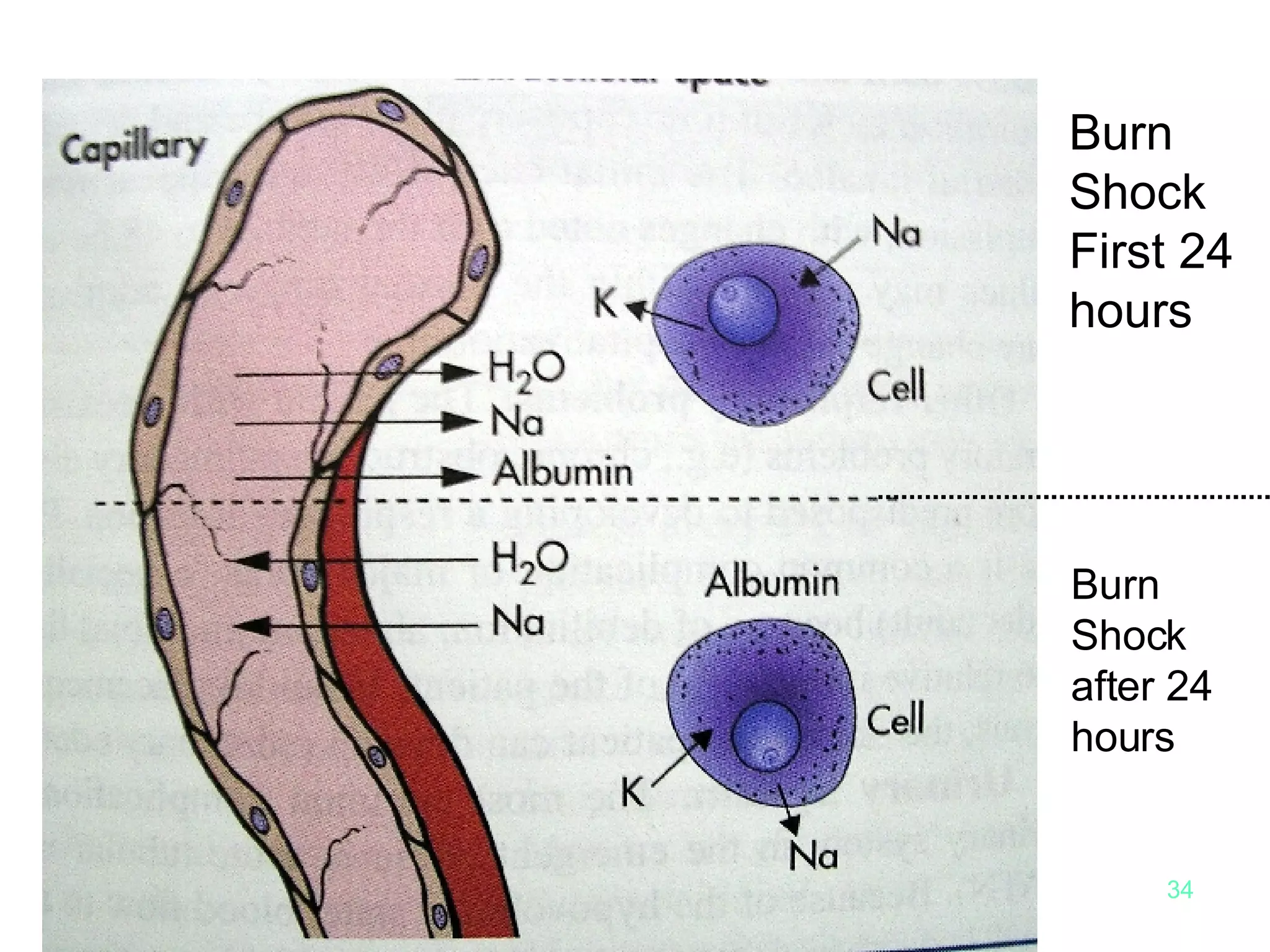 Burn And Scald | PPT