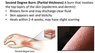 Burn first aid ppt | PPTX