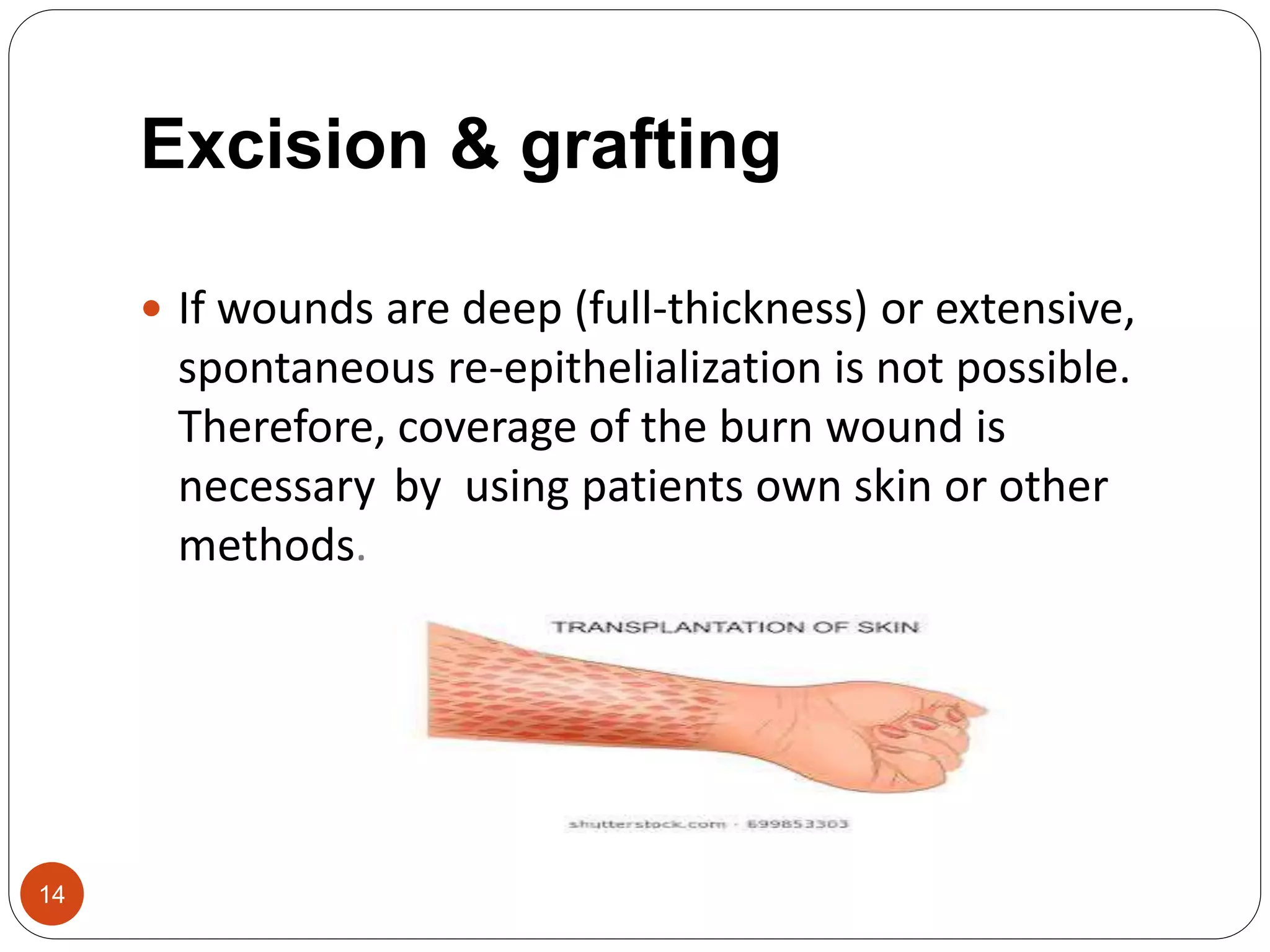 Burn (3 rd year) | PPTX