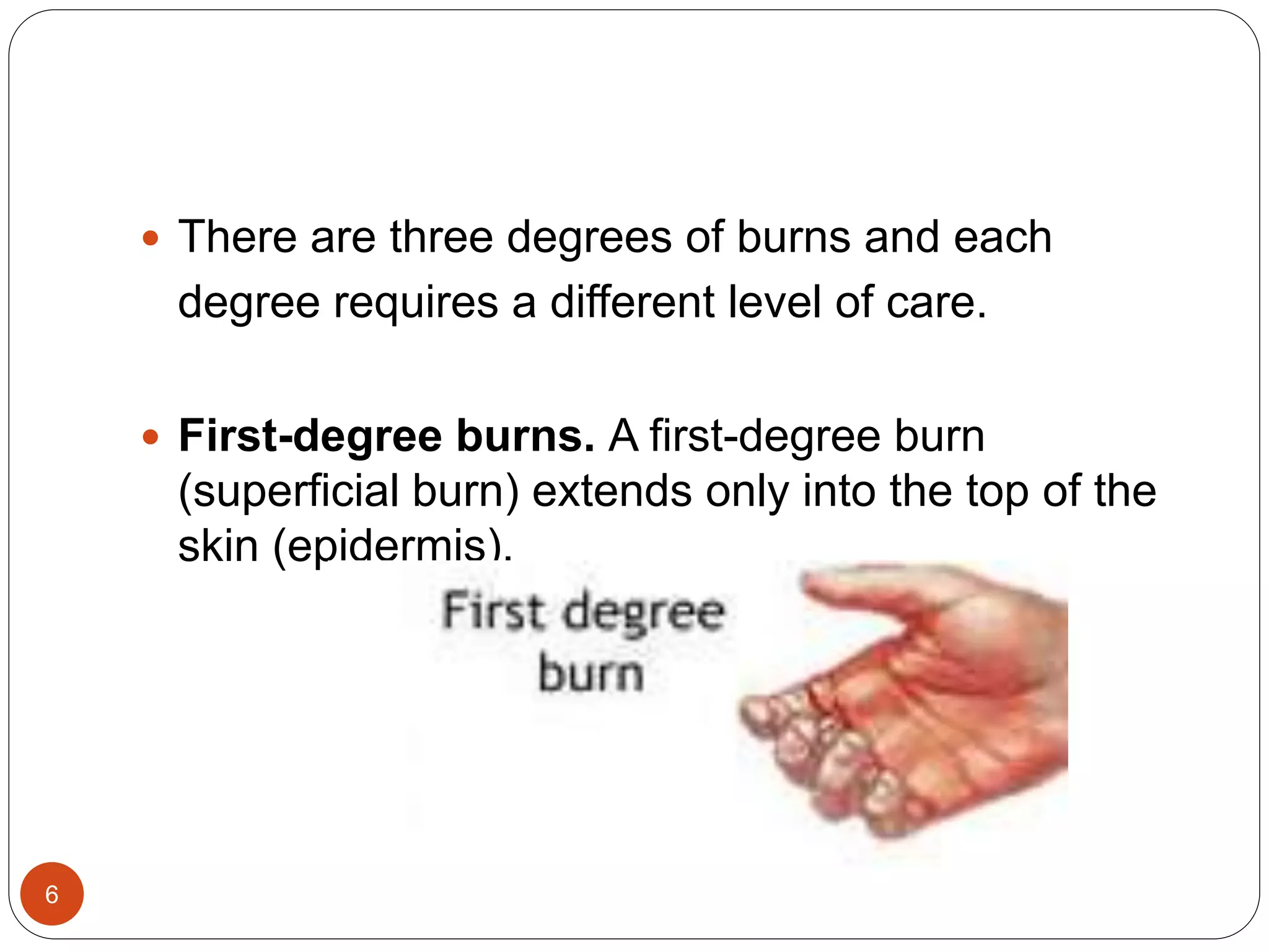 Burn (3 rd year) | PPTX