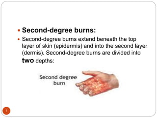 Burn (3 rd year) | PPTX