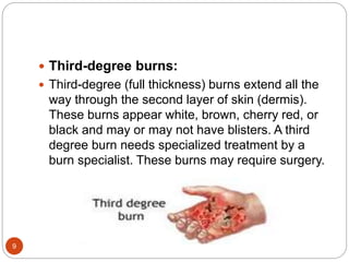 Burn (3 rd year) | PPTX