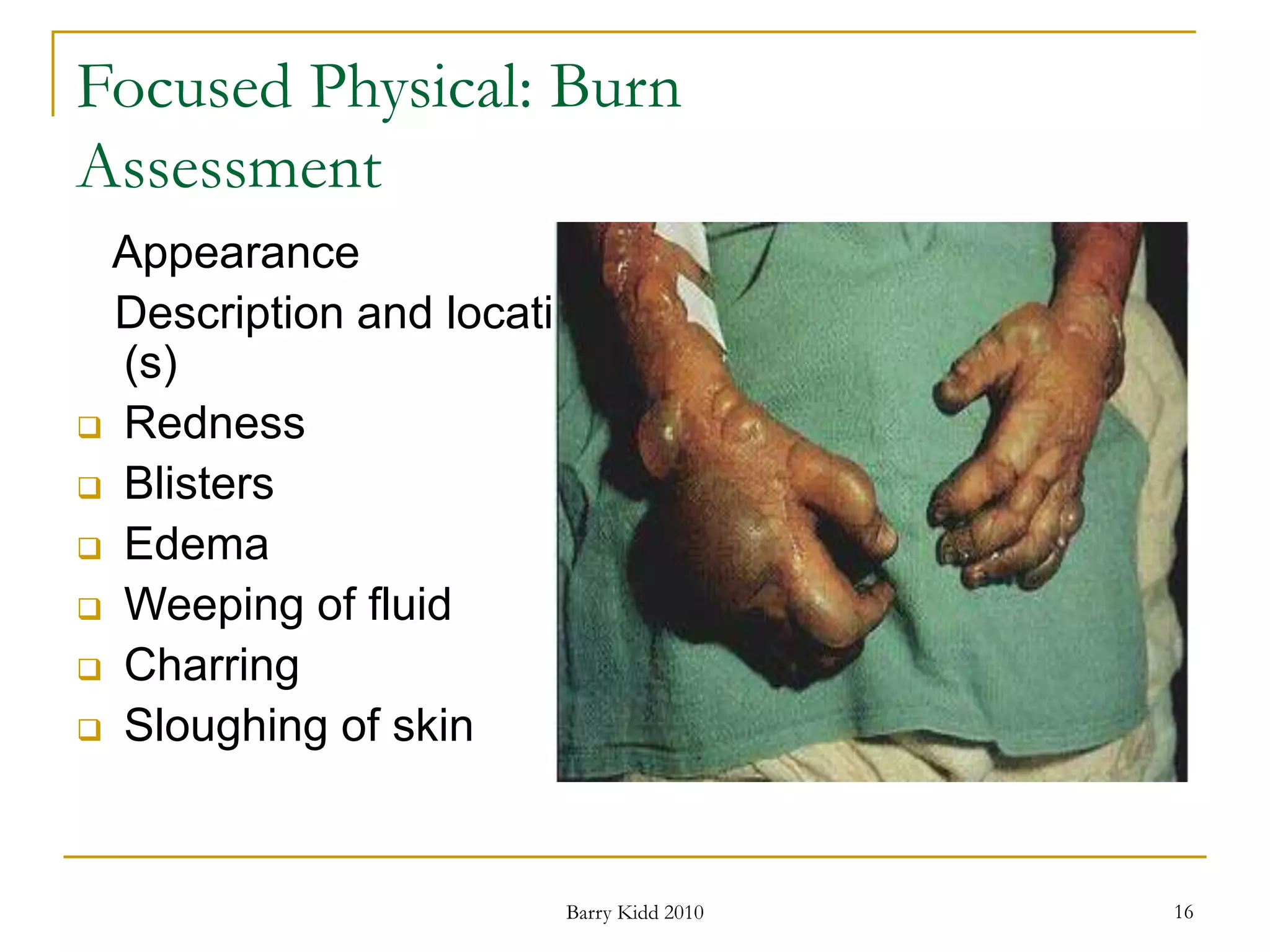 Burn assessment and management | PPT | First Aid | Injuries