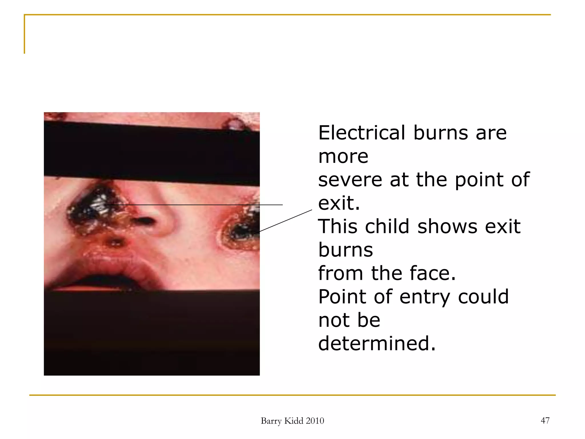 Burn assessment and management | PPT