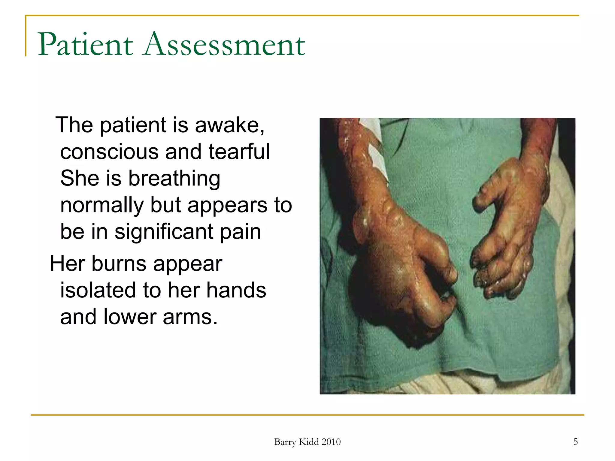 Burn assessment and management | PPT