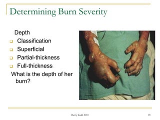Burn assessment and management | PPT
