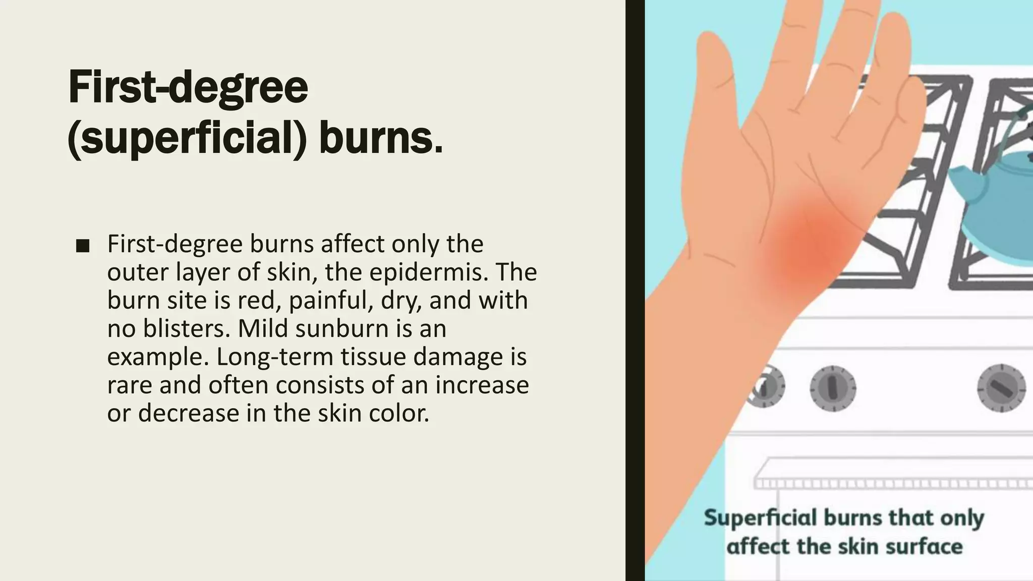 Burn classification | PPT