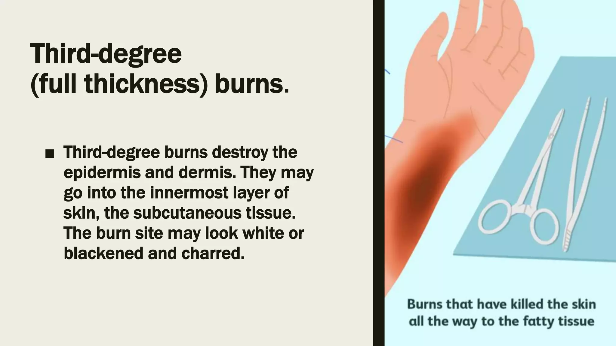 Burn classification | PPTX