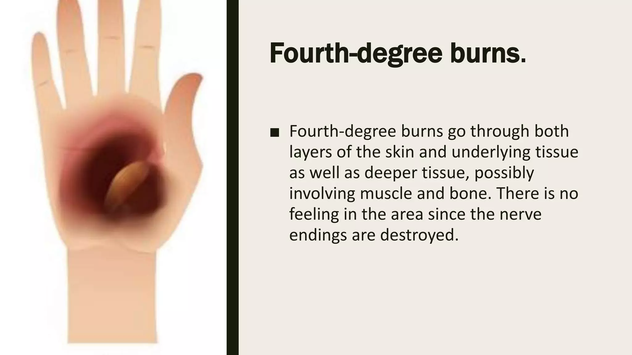 Burn classification | PPTX