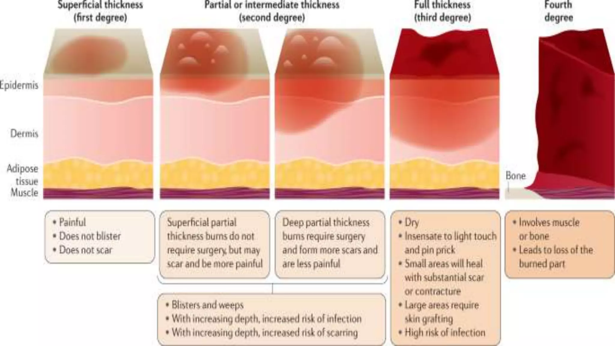 Burn classification | PPT