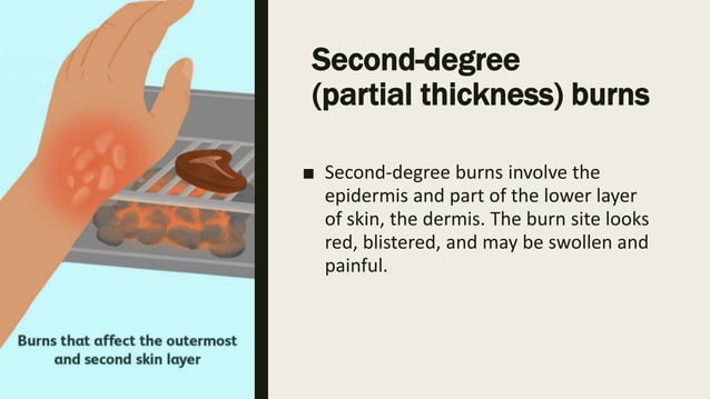 Burn classification | PPT