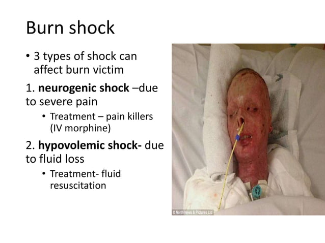 Burn complications and rehabilitation | PPTX | First Aid | Injuries