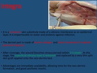 Dressings in Burn Wound, skin graftin, artificial skin and cadaveric ...