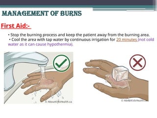 BURN management classification treatment | PPT
