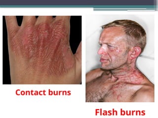 BURN management classification treatment | PPT