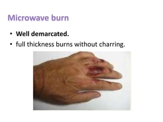 Burn(dry heat) | PPT