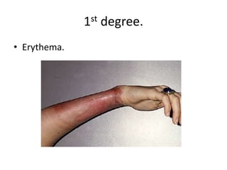 Burn(dry heat) | PPT