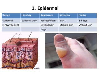 Burn(dry heat) | PPT