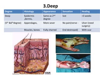Burn(dry heat) | PPT
