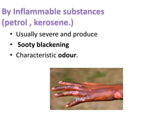 Burn(dry heat) | PPT