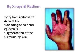 Burn(dry heat) | PPT