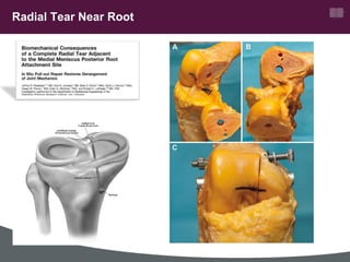 Factors Affecting Meniscus Tear Healing and Prognosis - AOSSM Lecture | PPT