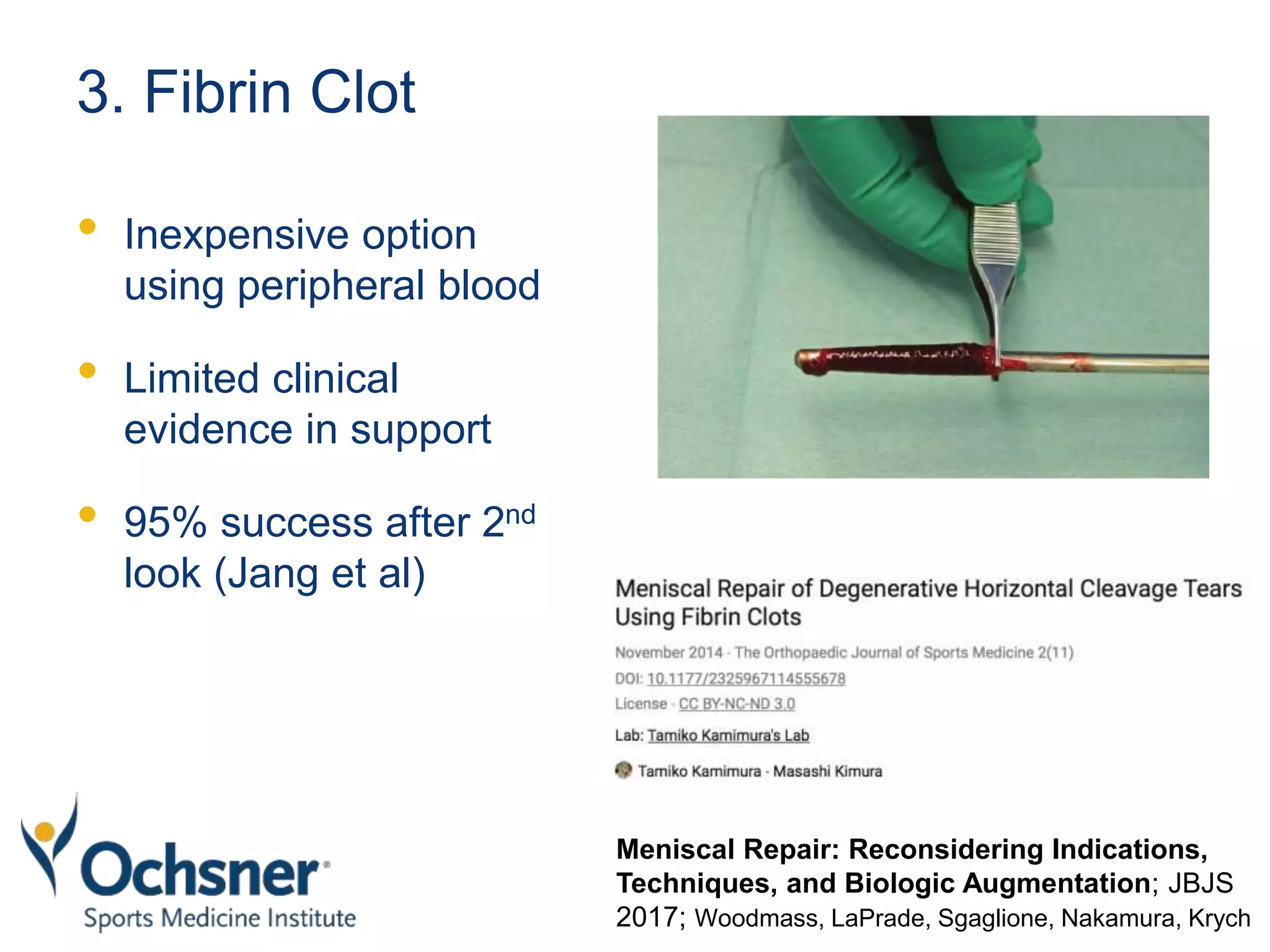 Meniscus Repair with Biologic Augmentation | Baton Rouge Sports ...