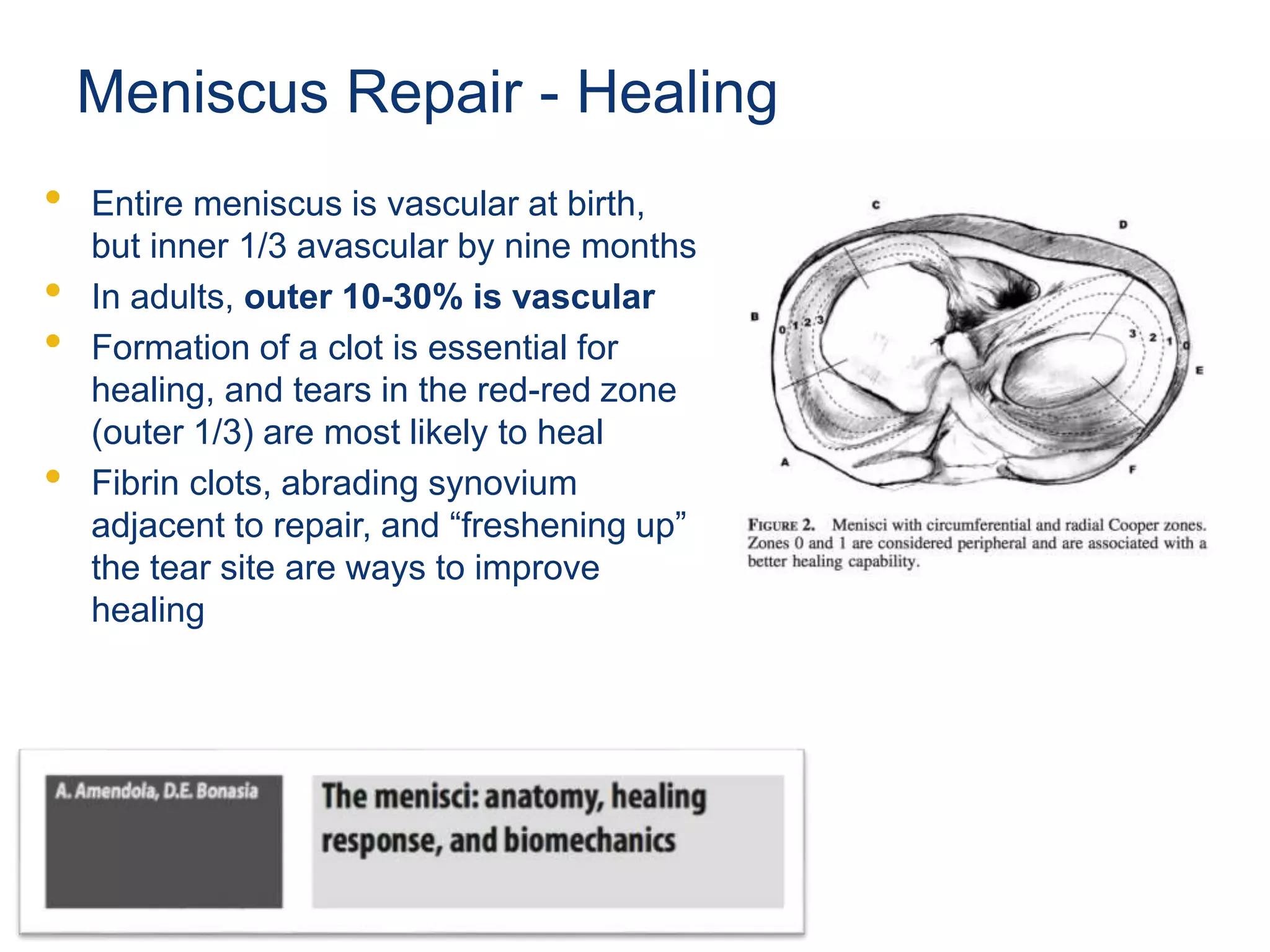 Meniscus Repair with Biologic Augmentation | Baton Rouge Sports ...