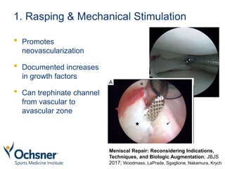 Meniscus Repair with Biologic Augmentation | Baton Rouge Sports ...