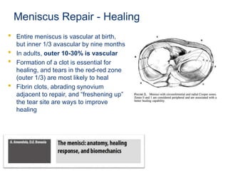 Meniscus Repair with Biologic Augmentation | Baton Rouge Sports ...