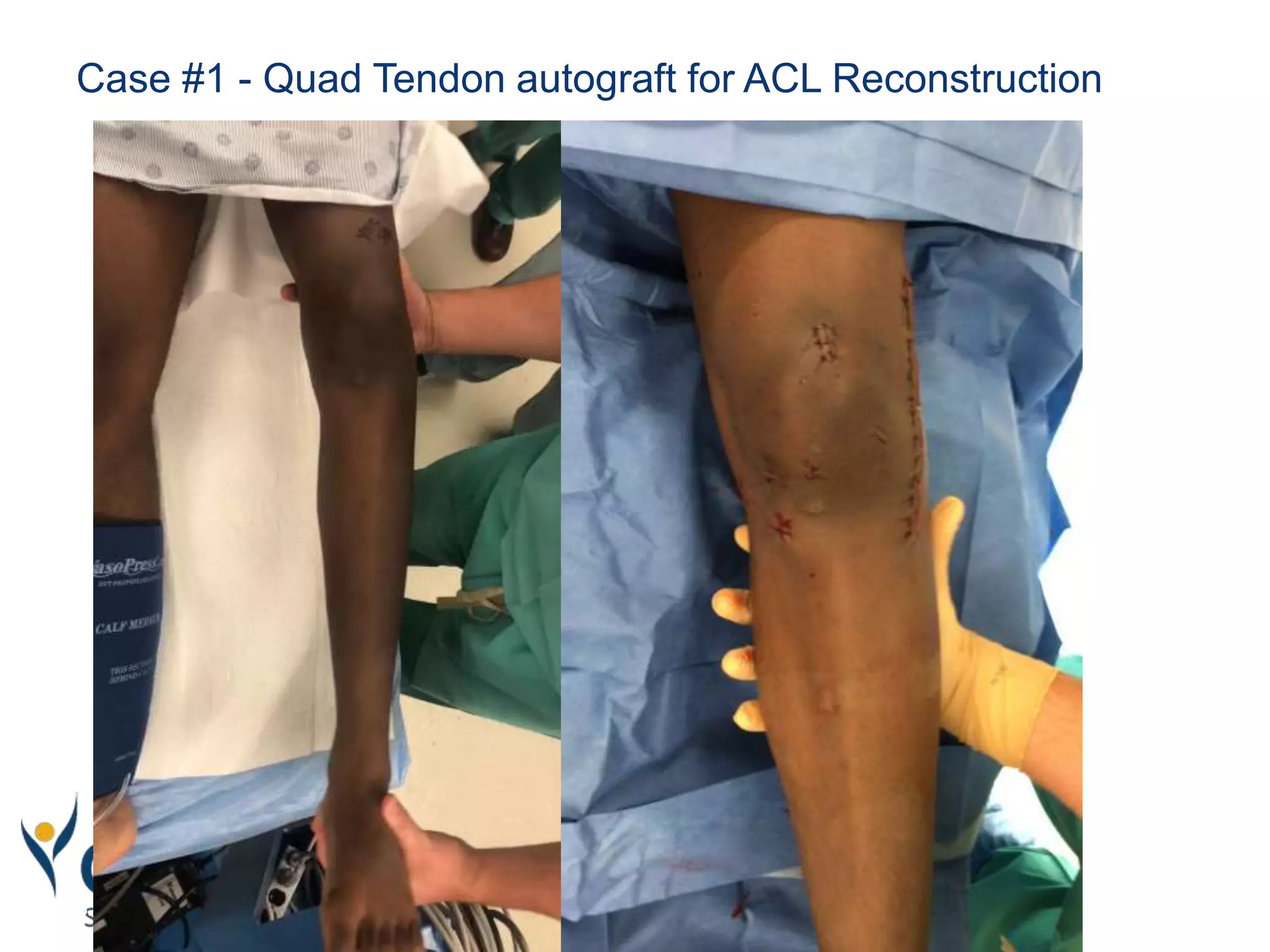 Posterolateral Knee Ligament Reconstruction | PPTX