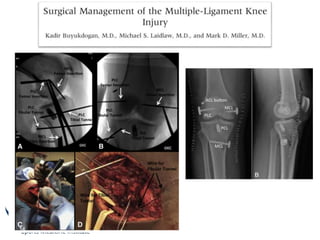 Posterolateral Knee Ligament Reconstruction | PPTX